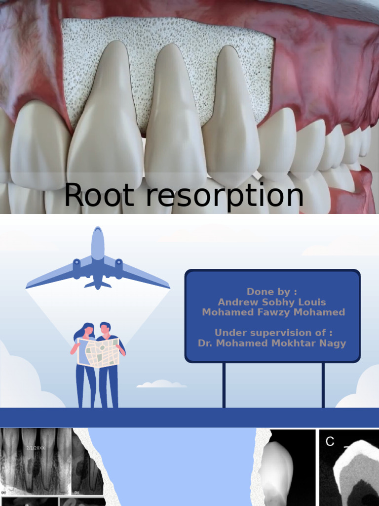 Root Resorption Seminar Final | PDF