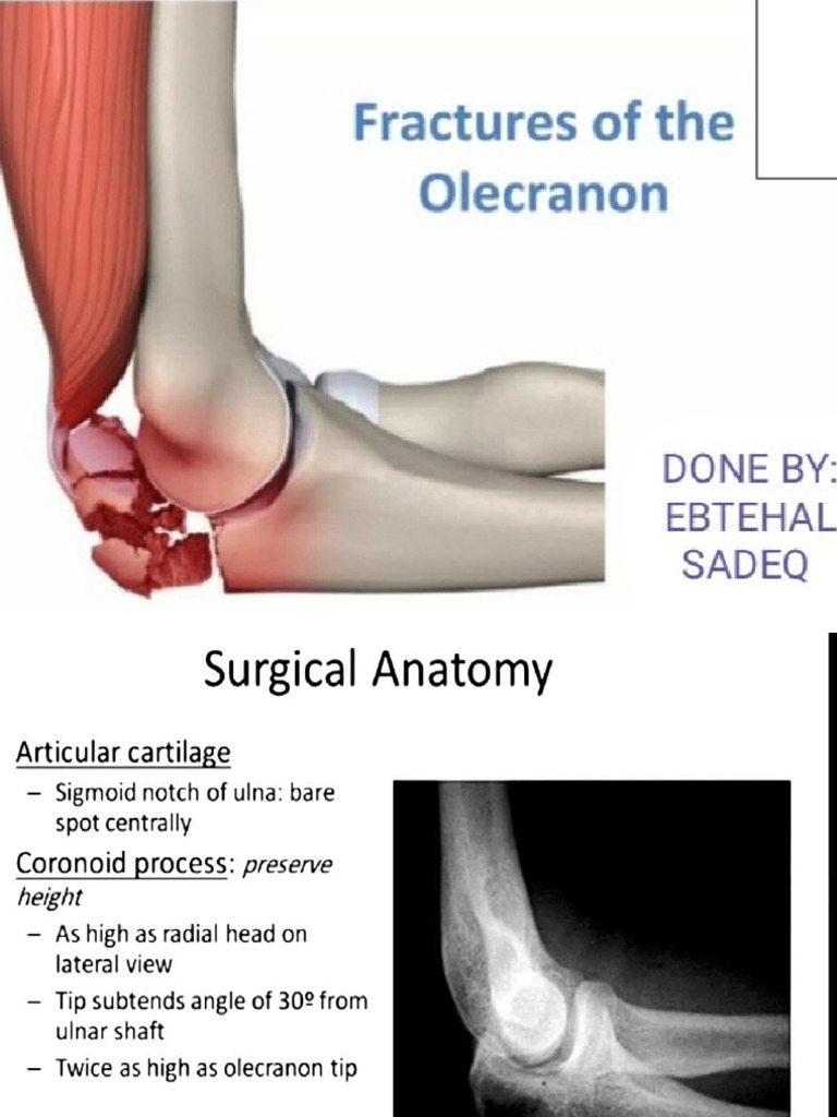 Olecranon Fracture | PDF