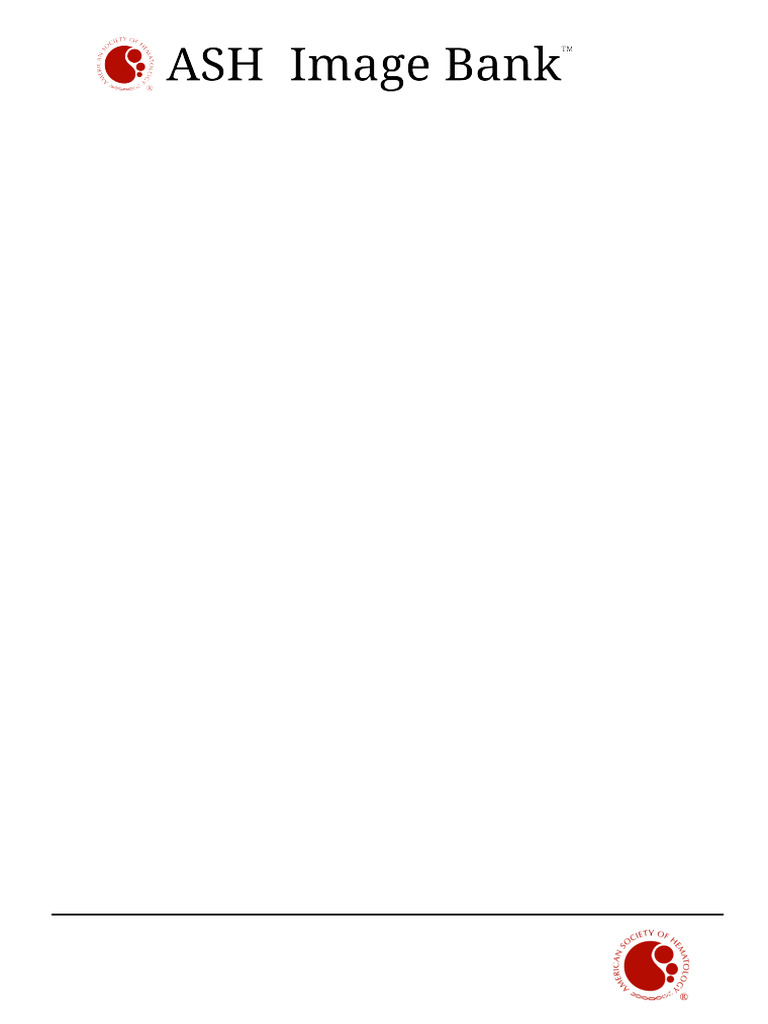 144-Double Heterozygous HBSD Disease With Sickling Syndrome in A Child ...