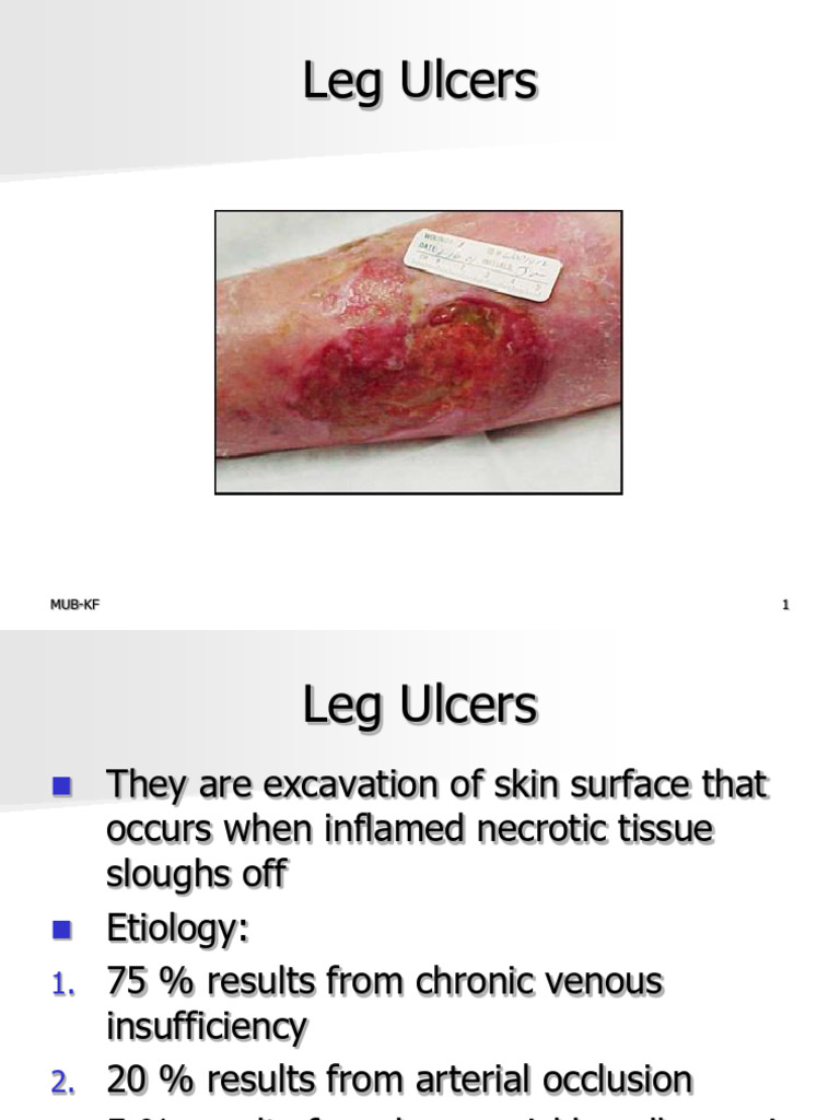 Leg Ulcers | PDF
