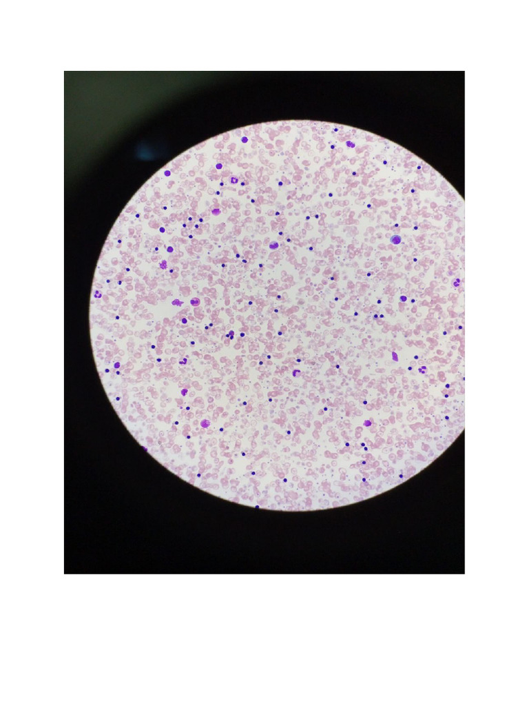 Example of Blood Peripheral | PDF