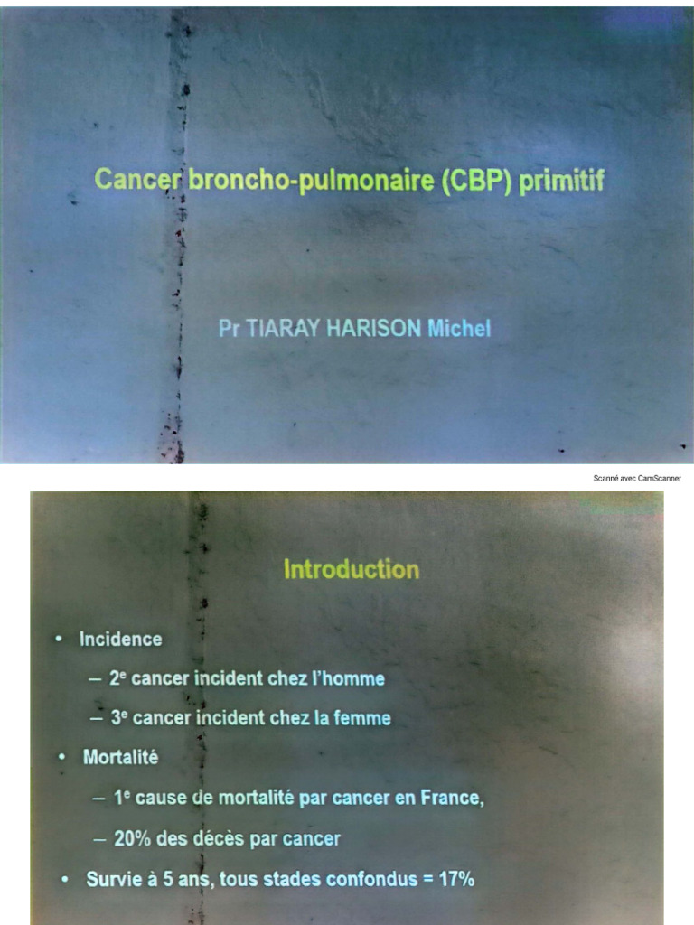 Cancer Broncho-Pulmonaire (CBP) Primitif | PDF