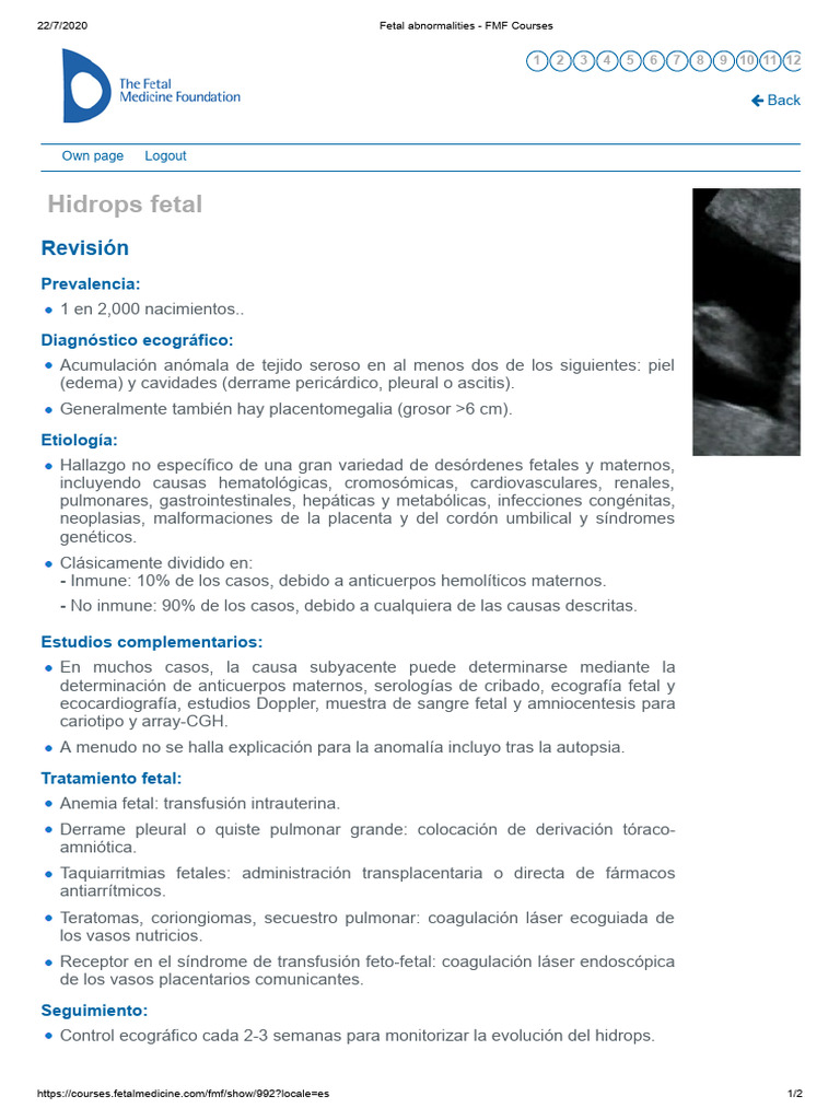 20 Hidrops Fetal FMF | PDF