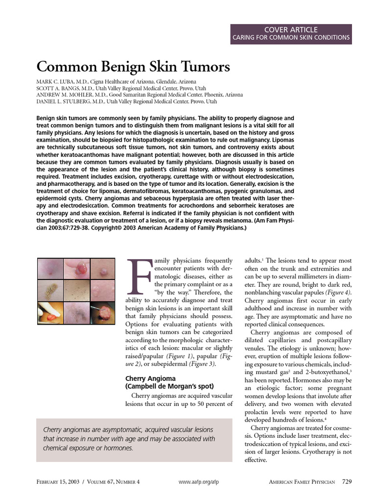 AAFP Common Benign Skin Tumors | PDF