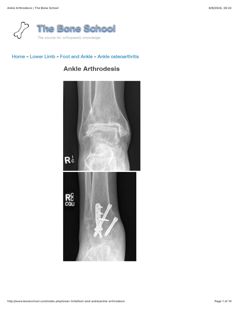 Ankle Arthrodesis Techniques Guide | PDF | Ankle | Foot