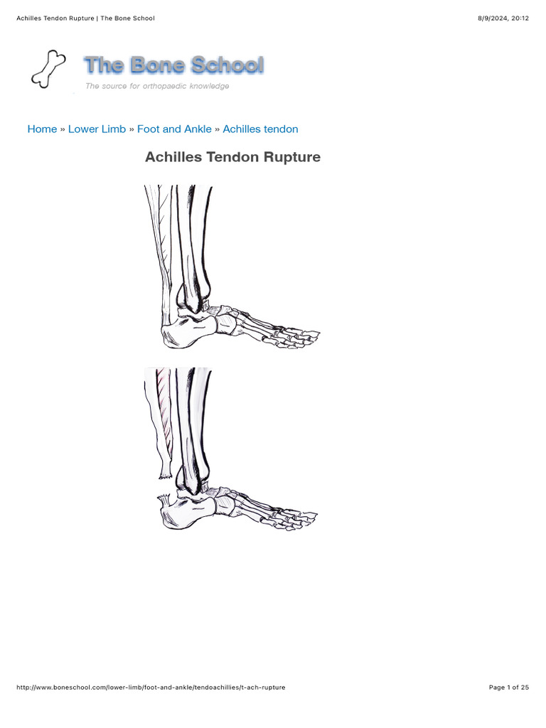 Achilles Tendon Rupture | the Bone School | PDF | Limbs (Anatomy) | Musculoskeletal System