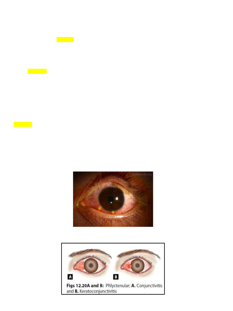 Phlyctenular Conjunctivitis | PDF