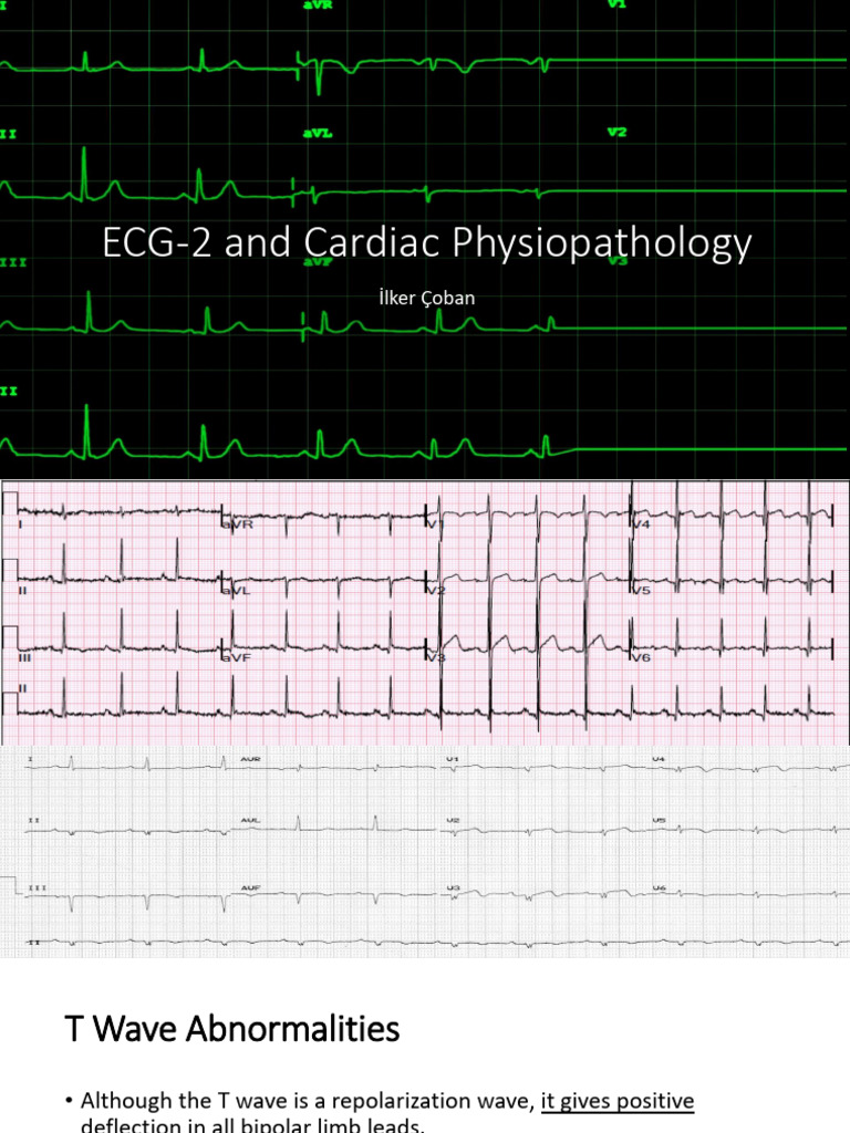 ECG-2 and Cardiac Physiopathology | PDF