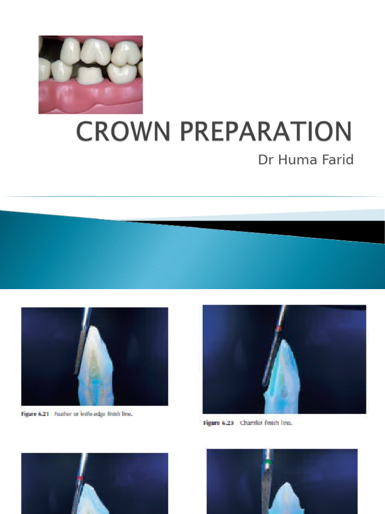 Crown Preparation | PDF | Dentistry Branches