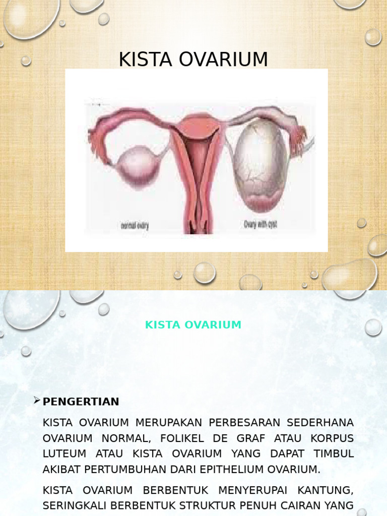 Kista Ovarium | PDF