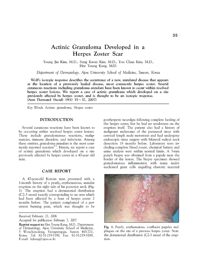 Actinic Granuloma Developed in A Herpes Zoster Scar | PDF