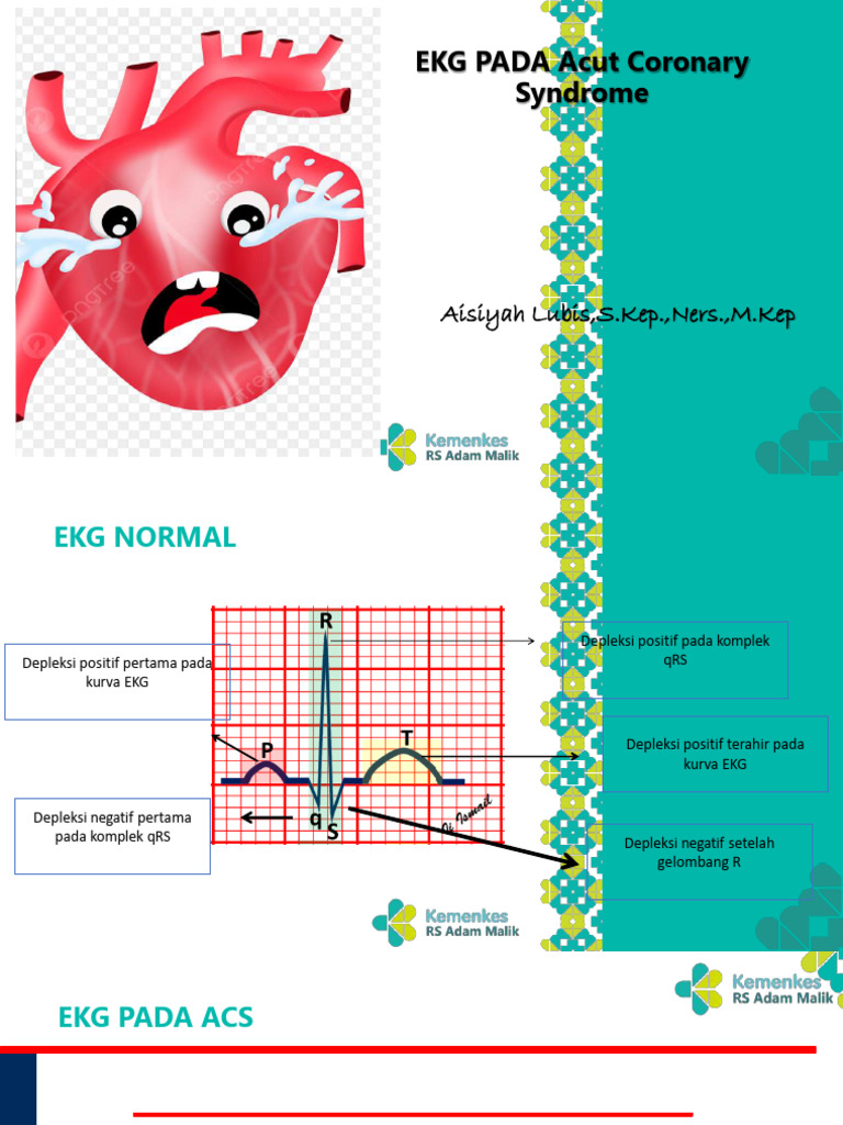 EKG Pada ACS-ai | PDF