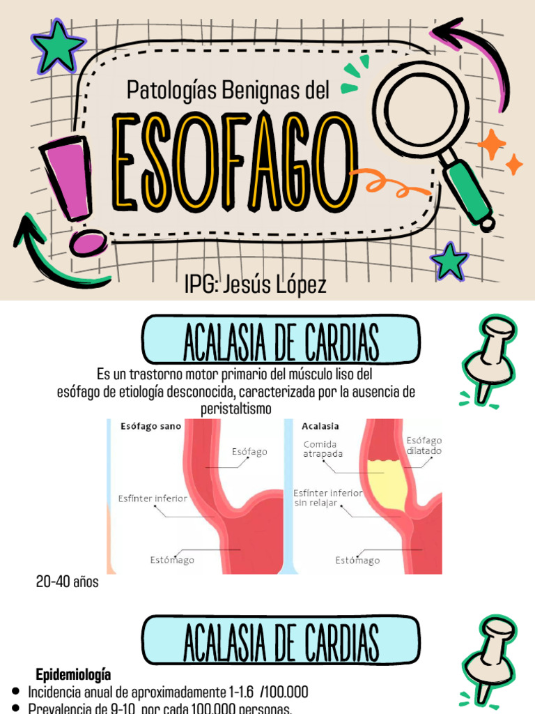 Patologías Benignas del esofago | PDF