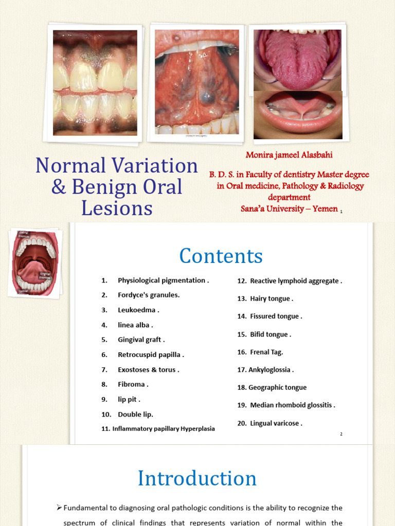 Normal Variation & Benign Oral Lesions | PDF