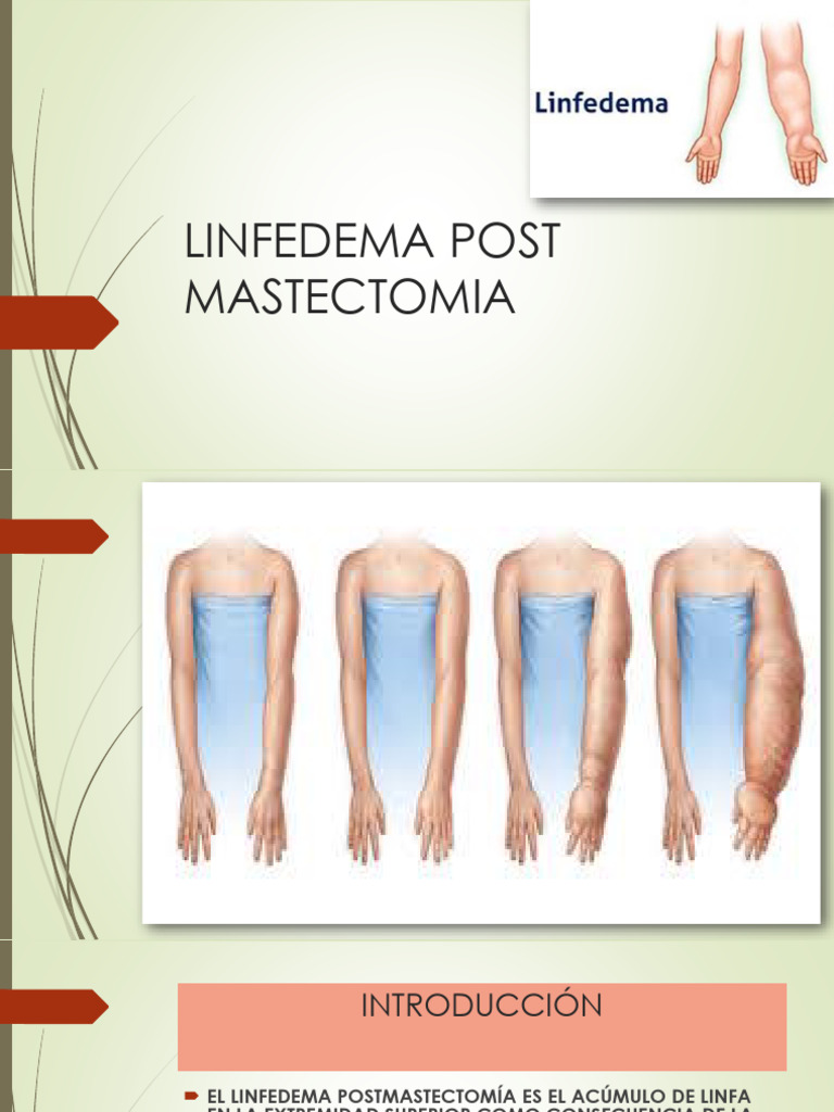 Linfedema Post Mastectomia | PDF | Sistema linfático | Linfa