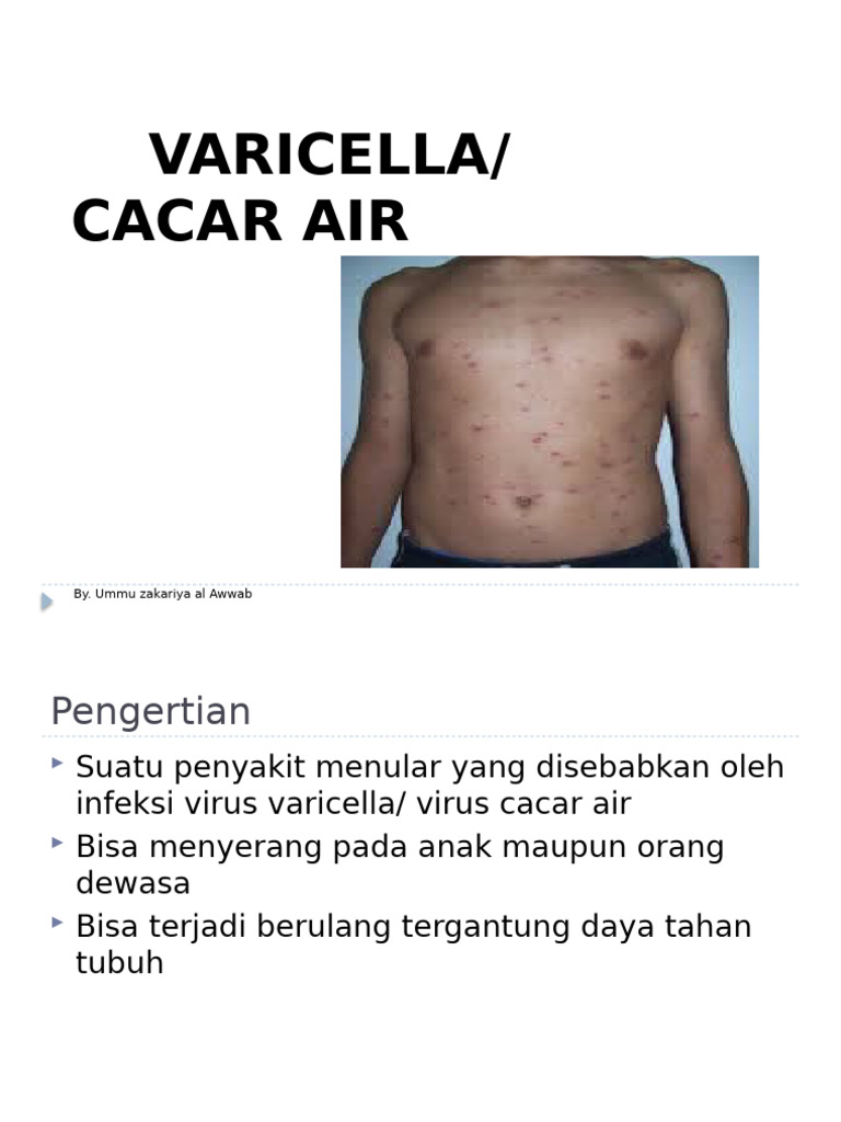 Varicella | PDF