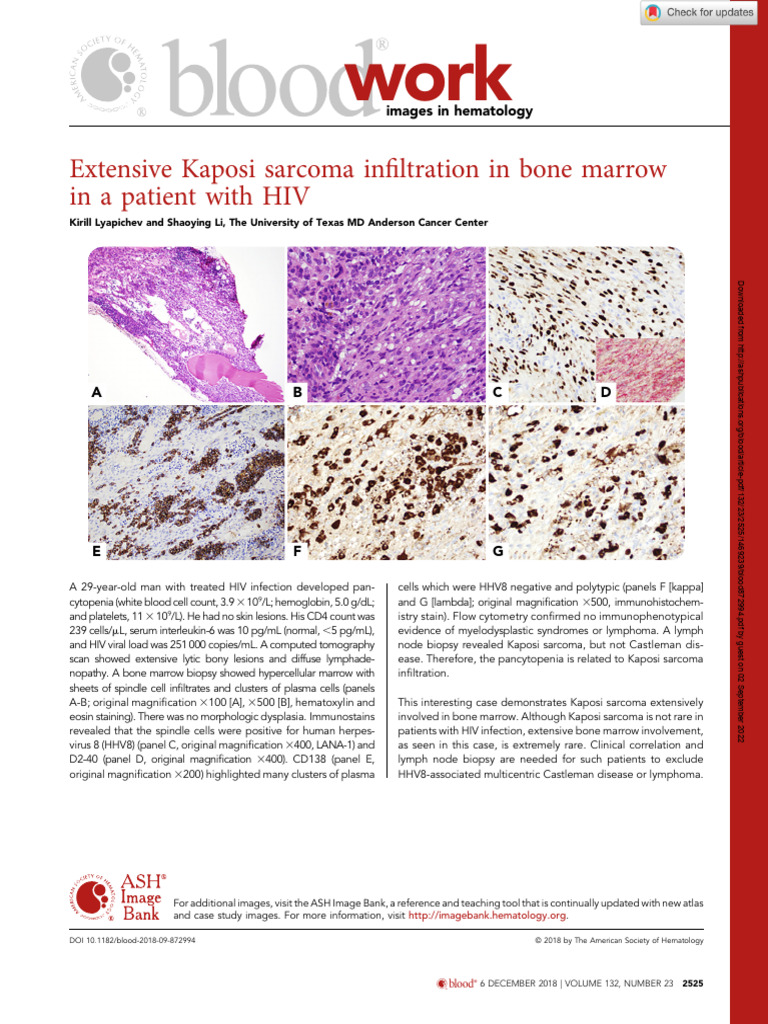 Extensive Kaposi Sarcoma Infiltration in Bone Marrow in A Patient With HIV | PDF | Hiv | Lymphoma