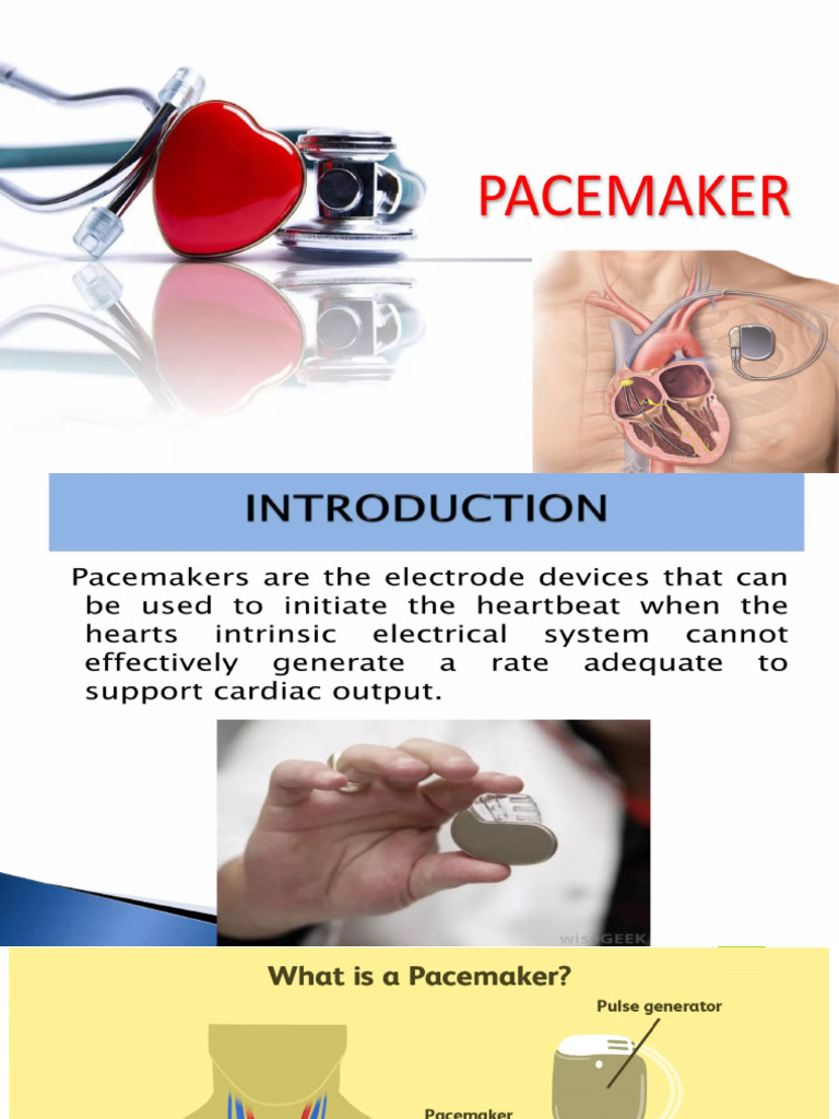 Pacemaker | PDF