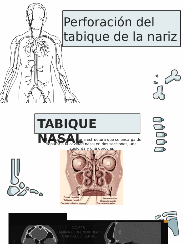 Perforación Del Tabique Nasal - Presentacion | PDF