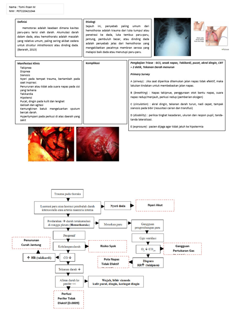Woc Hematothorax | PDF