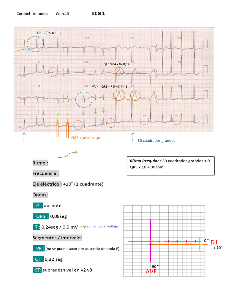 Ecg 1 | PDF