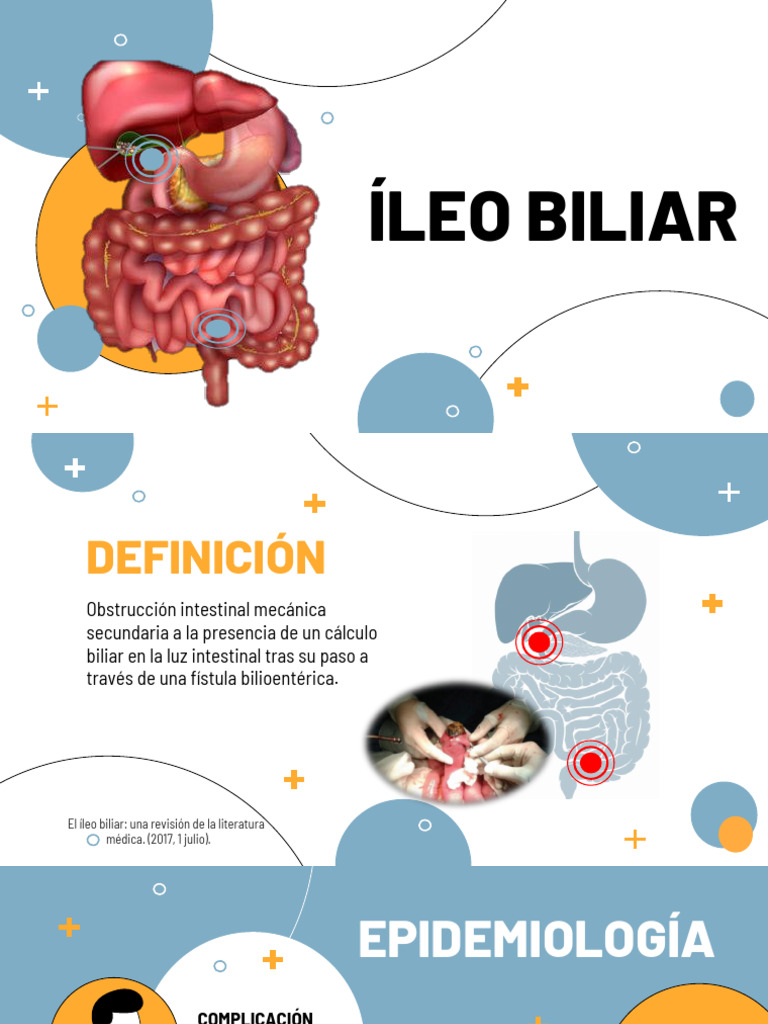 Íleo Biliar: Obstrucción Intestinal por Cálculo | PDF ...