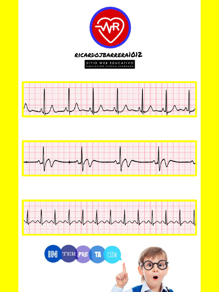 PDF 1 Ekg Ritmo Sinusal | PDF