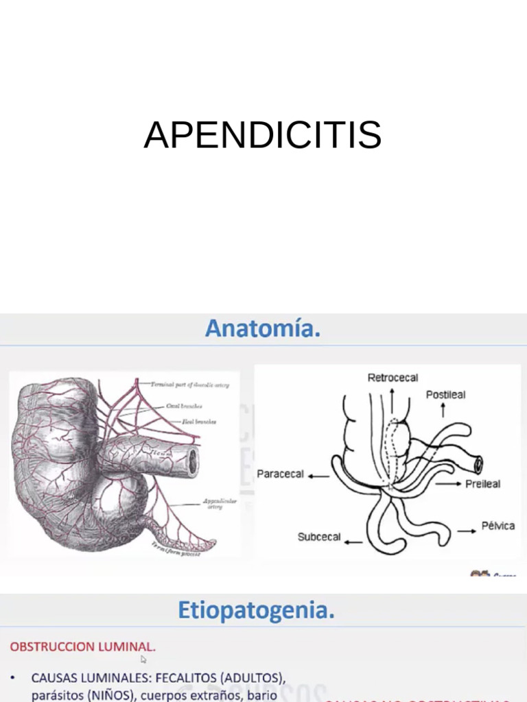 Apendicitis | PDF