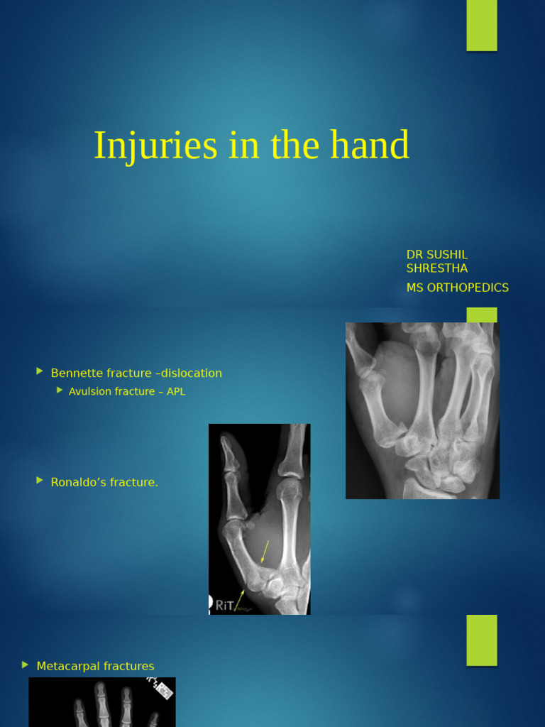 Fractures in The Hand | PDF