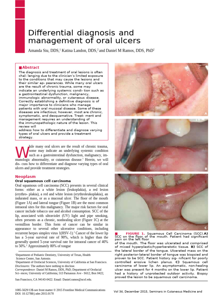 SCMS-v34i4-Differential-Diagnosis-and-management-of-oral-ulcers | PDF