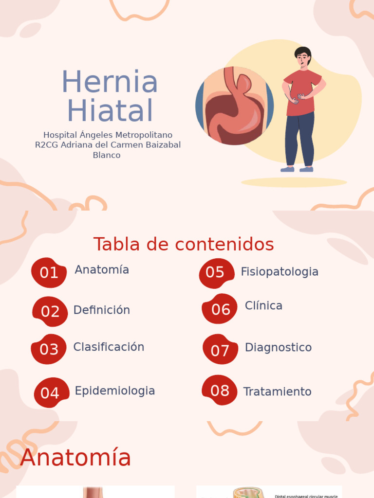Hernia Hiatal | PDF