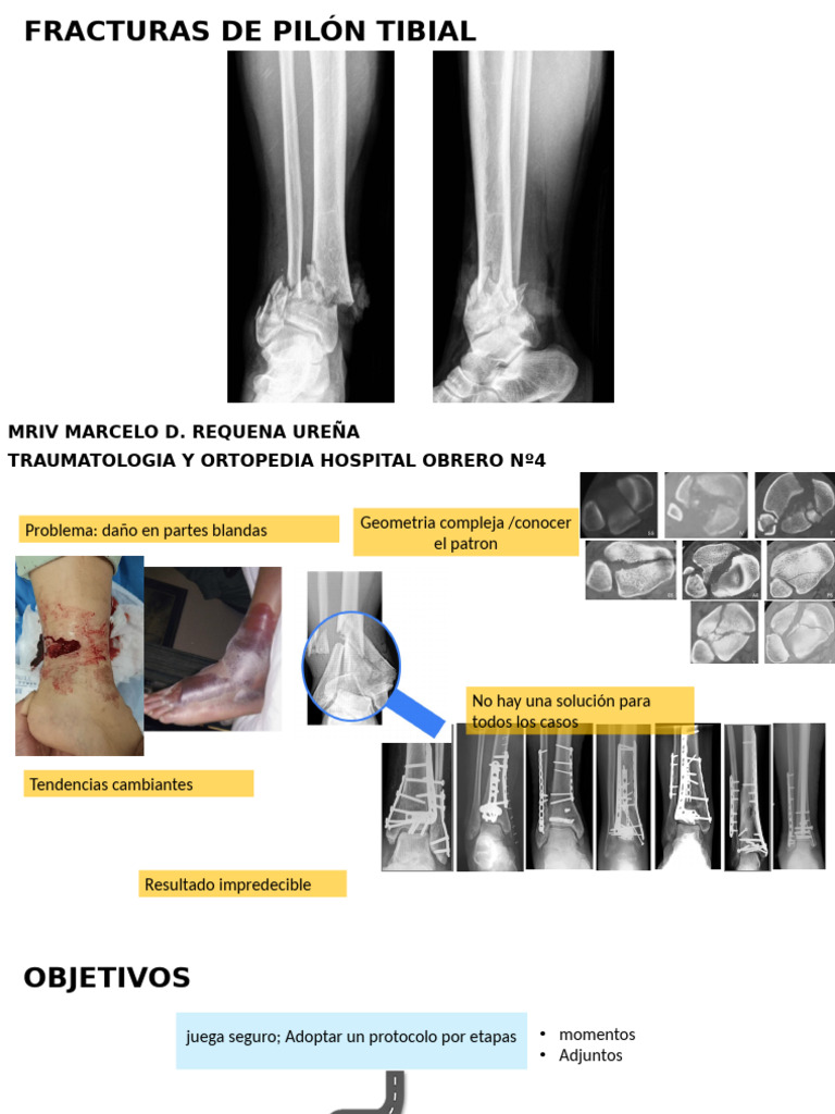 Presentación Pilon Tibial OF | PDF