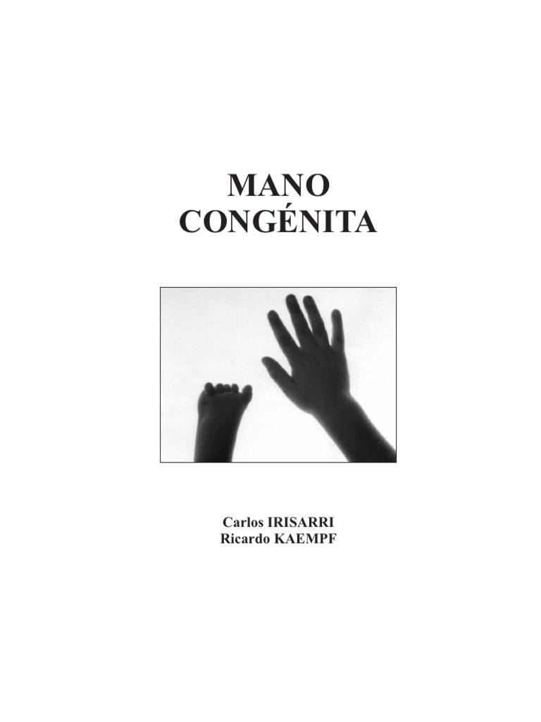 Anomalías Congénitas de la Mano | PDF | Mano