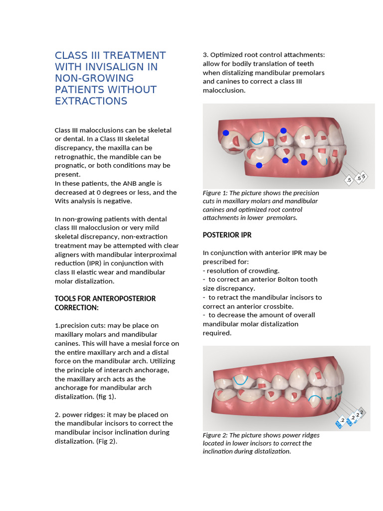 Abstract CLASS III TREATMENT WITH INVISALIGN IN NON GROWING PATIENTS ...
