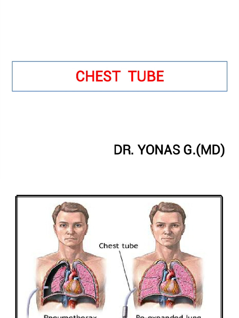 Chest Tube | PDF