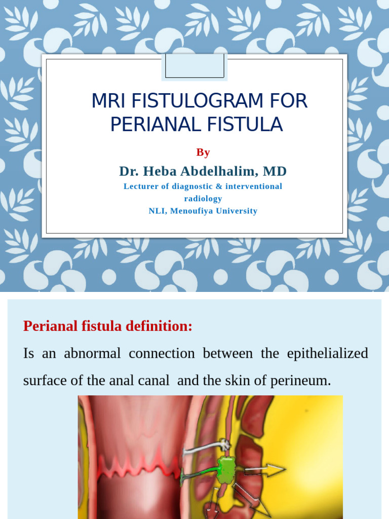 MRI Fistulogram For Perianal Fistula | PDF