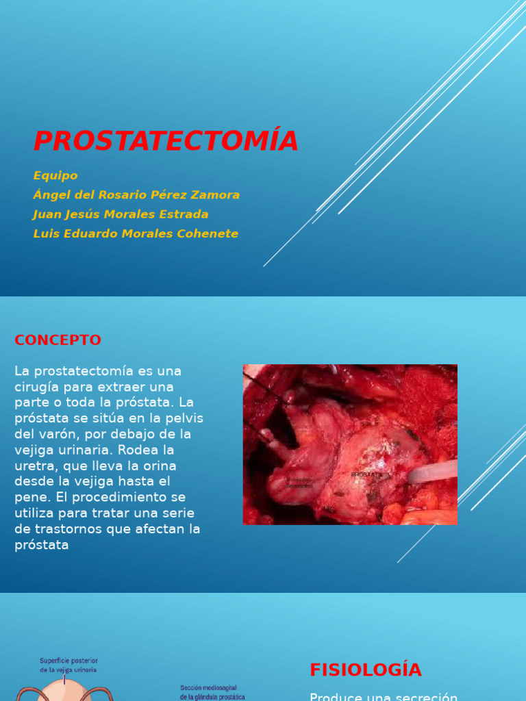 Prostatectomía | PDF