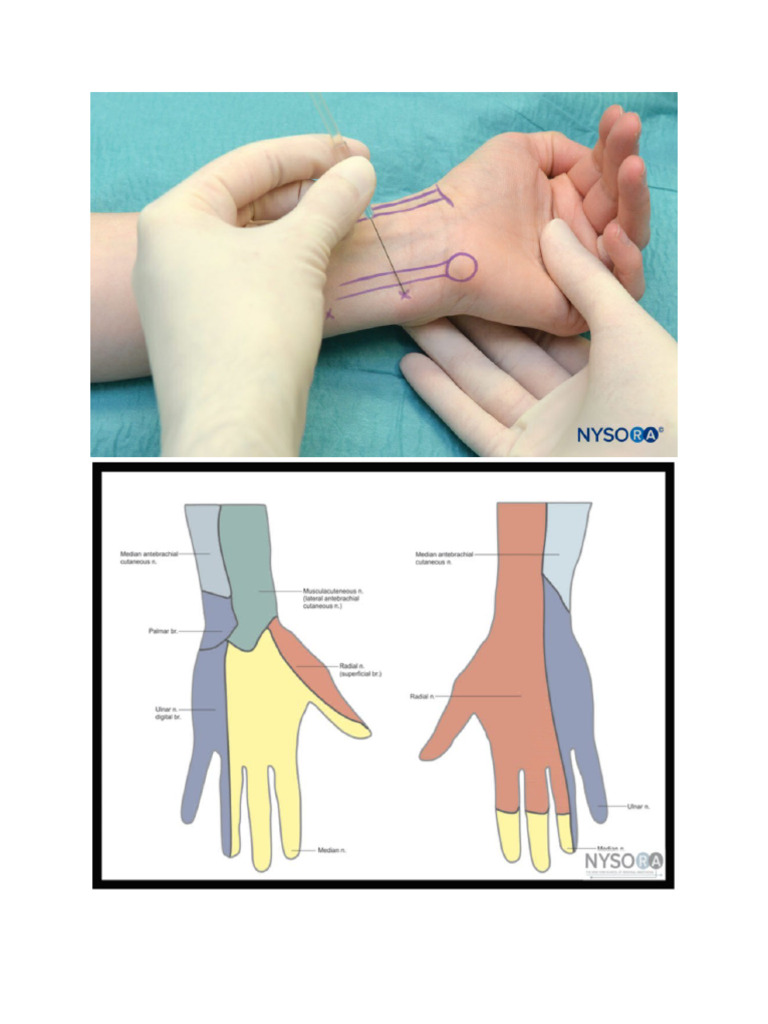 Anestezie locala la maini | PDF