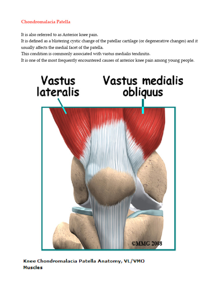 Chondromalacia Patella | PDF