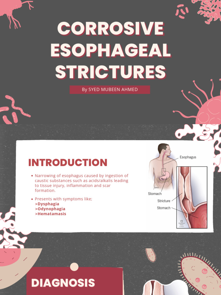 Corrosive Esophageal Strictures | PDF