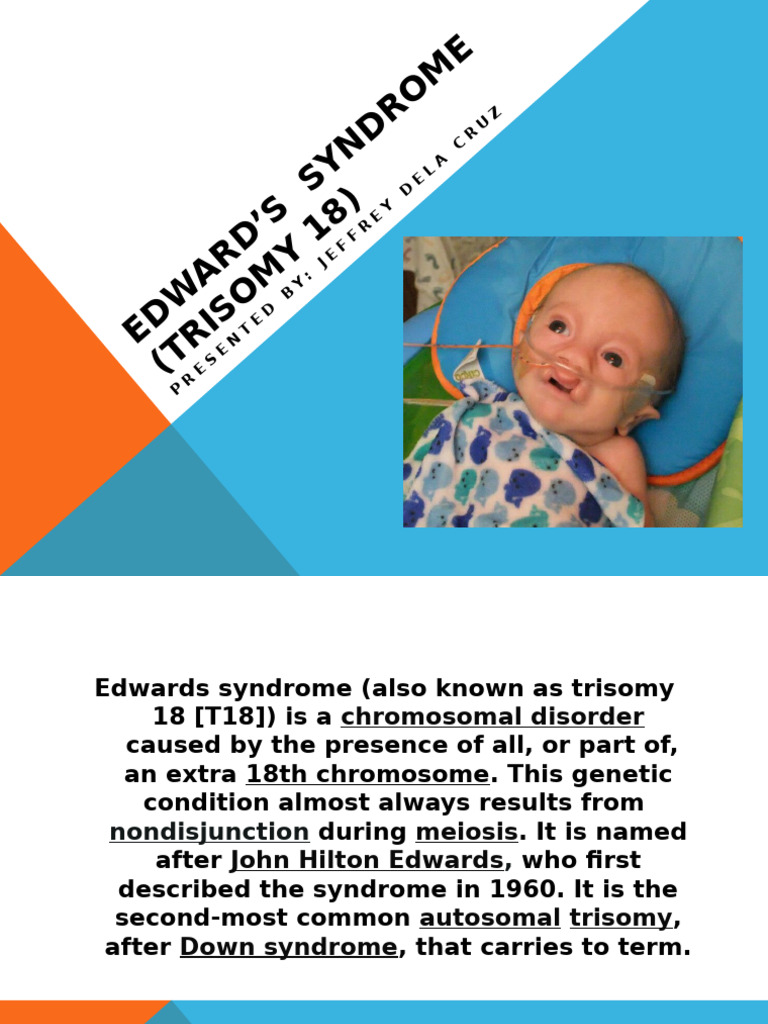 Edwards Syndrome Trisomy | PDF | Syndrome | Congenital Disorder