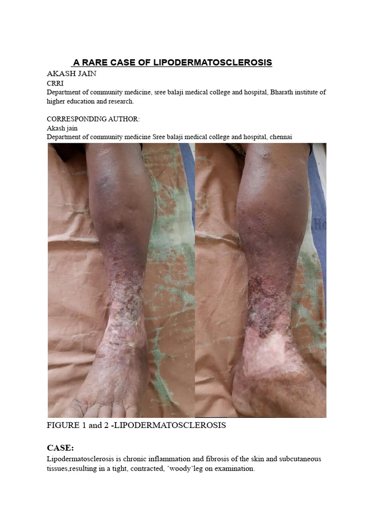 A Case of Lipodermatosclerosis | PDF | Science & Mathematics