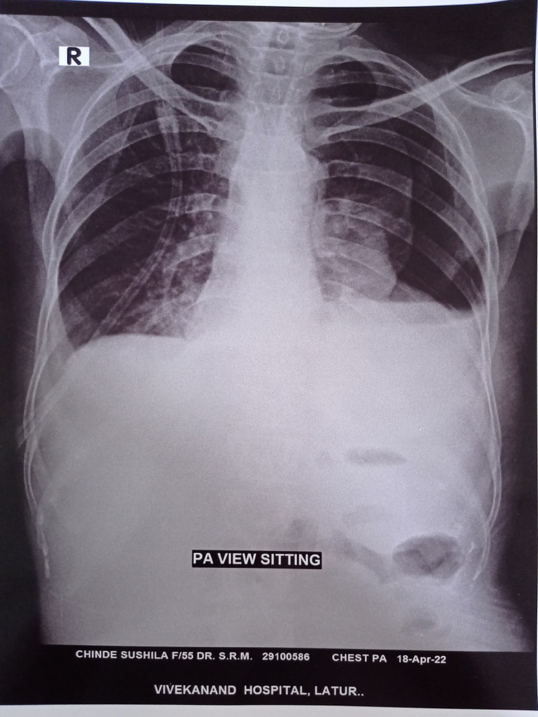 Chest Xray | PDF