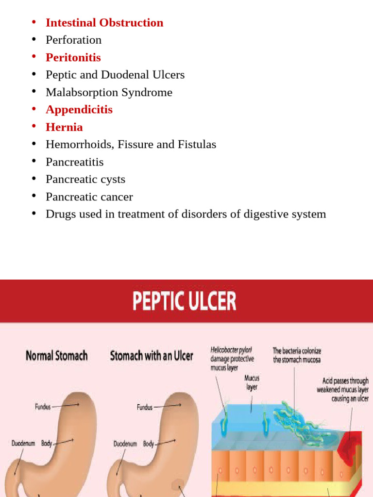 Peptic and Deudenal Ulcer 2024 | PDF