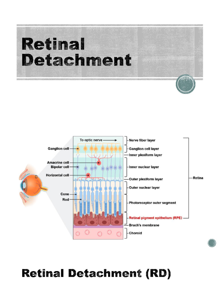 Retinal Detachment | PDF