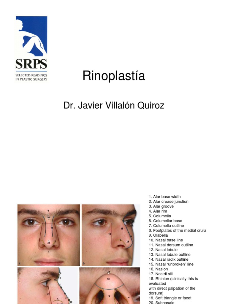 Rinoplastia