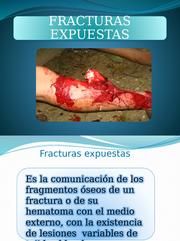 Fracturas Expuestas | PDF