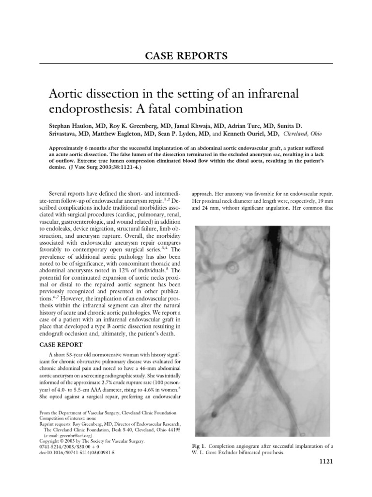 Aortic Dissection in The Setting of An Infrarenal | PDF