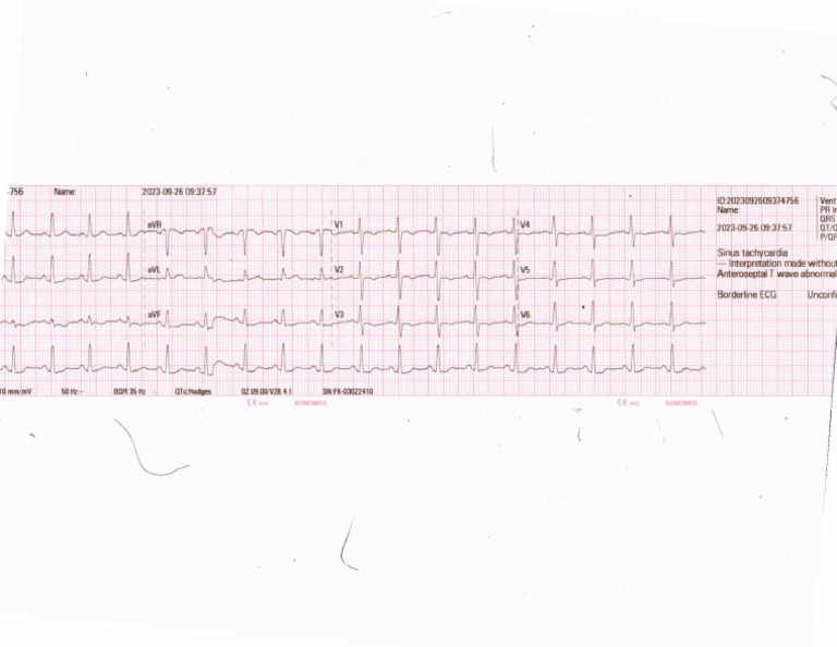 Ecg Ajeng Ragil | PDF