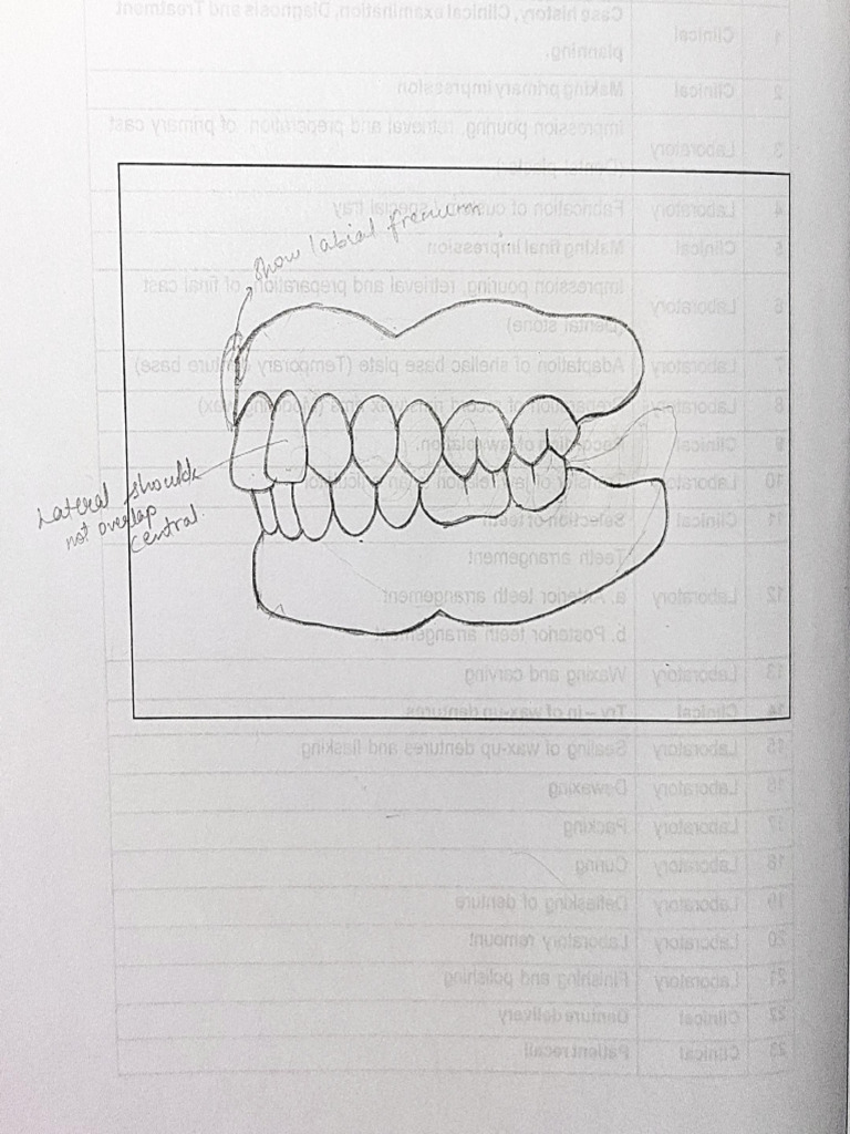 Complete Denture Anatomy Diagram | PDF | Mouth | Dentistry Branches